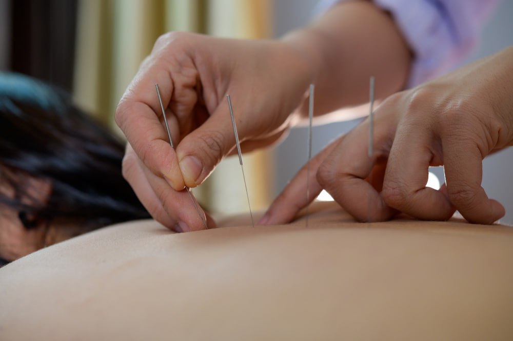 Understanding the Acupuncture Process: A Comprehensive Guide